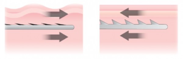 Fadenlifting - Facelifting ohne Op - 1030 Wien - Dr. Adib